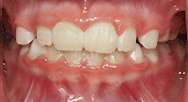 See How We Corrected This Crossbite In an 8-Year-Old Patient at Coleman ...
